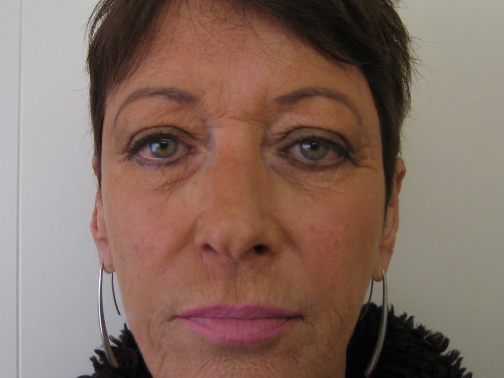after sculptra - Dr Teri Johnson specialising in Botox, Dermal Fillers ...