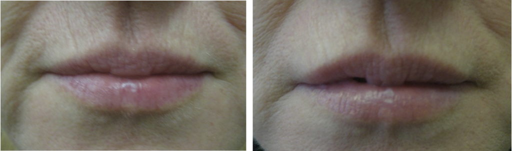 Lip Rejuvenation and treatments for lip lines by Dr Teri Johnson