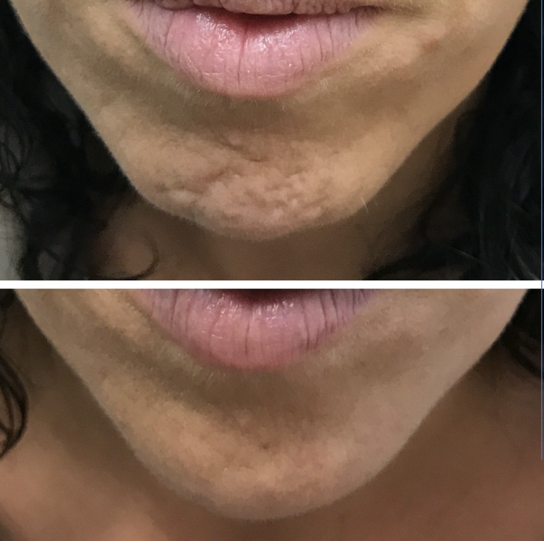 Dr Teri treats Chin wrinkles with Botox / Chin-tox in her Cheshire Clinic